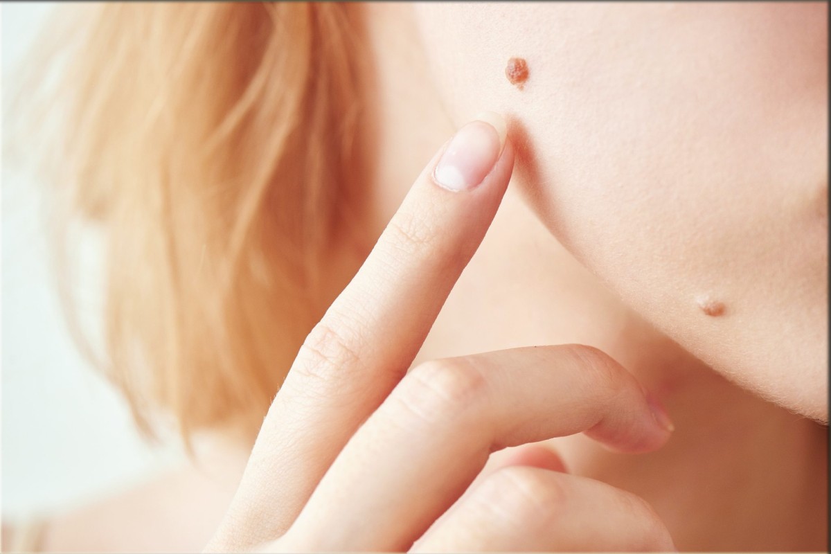ICD 10 Skin Tag Its Symptoms Treatment And Removal ICD 10 Skin Tag Its Symptoms Treatment And Removal